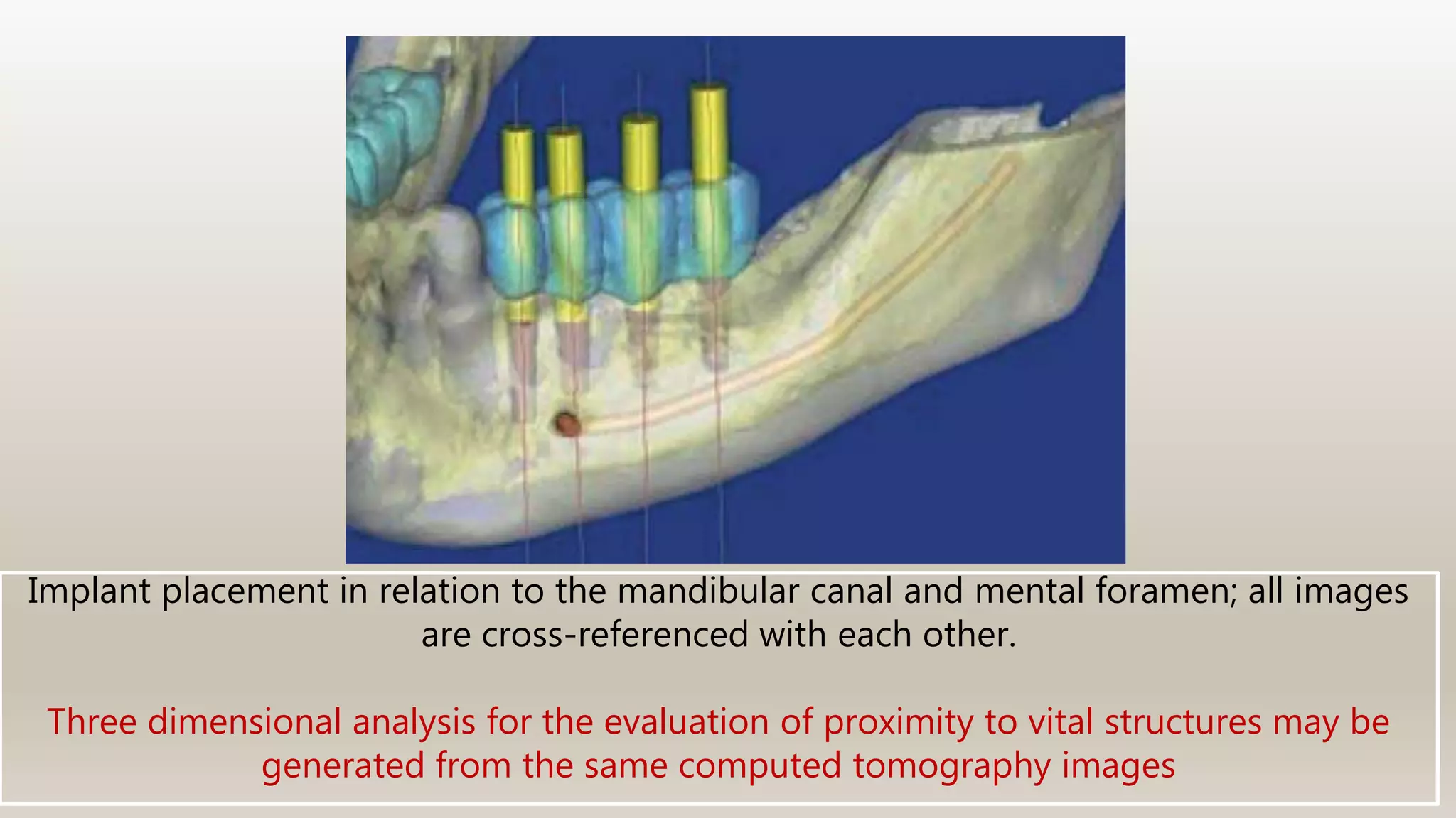Radiographic Considerations in Implants | PPTX | Dental Health ...