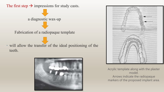 Radiographic Considerations in Implants | PPTX | Dental Health ...