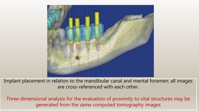 Radiographic Considerations in Implants | PPTX | Dental Health ...