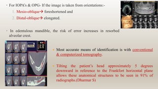 Radiographic Considerations in Implants | PPT