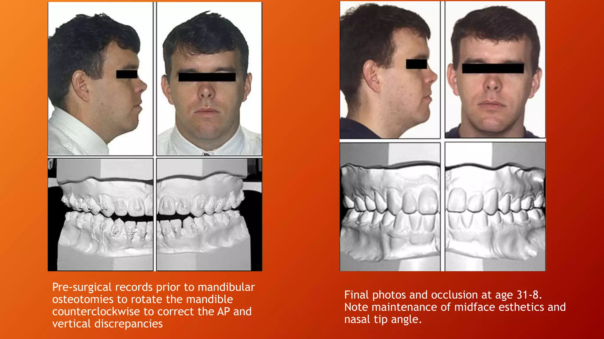 Orthognathic Surgical Procedure on non-growing patients with maxillary ...