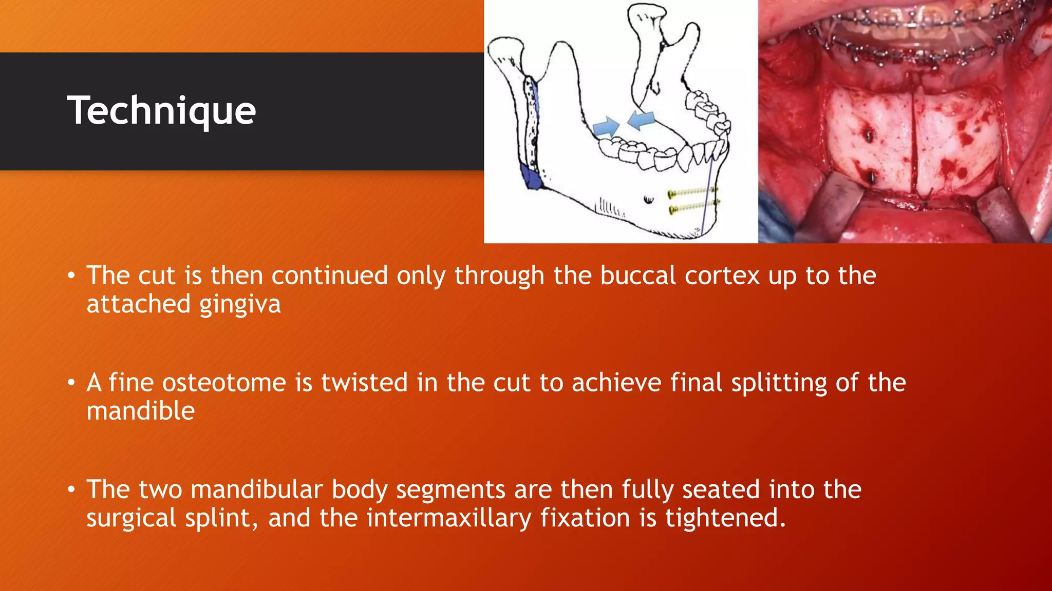 Orthognathic Surgical Procedure on non-growing patients with maxillary ...