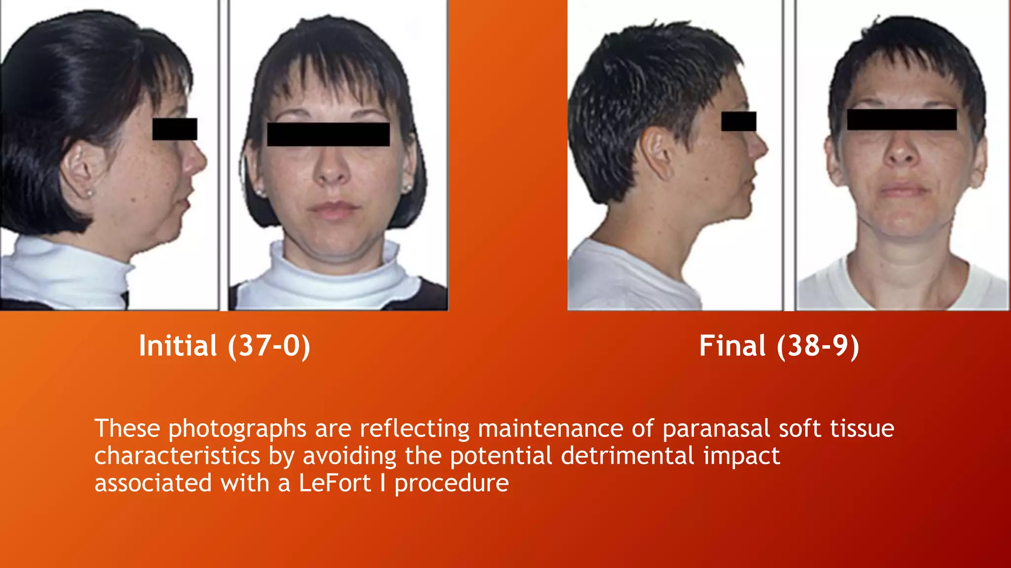 Orthognathic Surgical Procedure on non-growing patients with maxillary ...