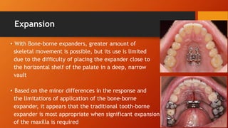 Orthognathic Surgical Procedure on non-growing patients with maxillary ...