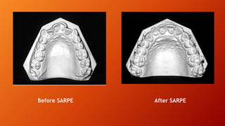 Orthognathic Surgical Procedure on non-growing patients with maxillary ...
