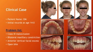 Orthognathic Surgical Procedure on non-growing patients with maxillary ...