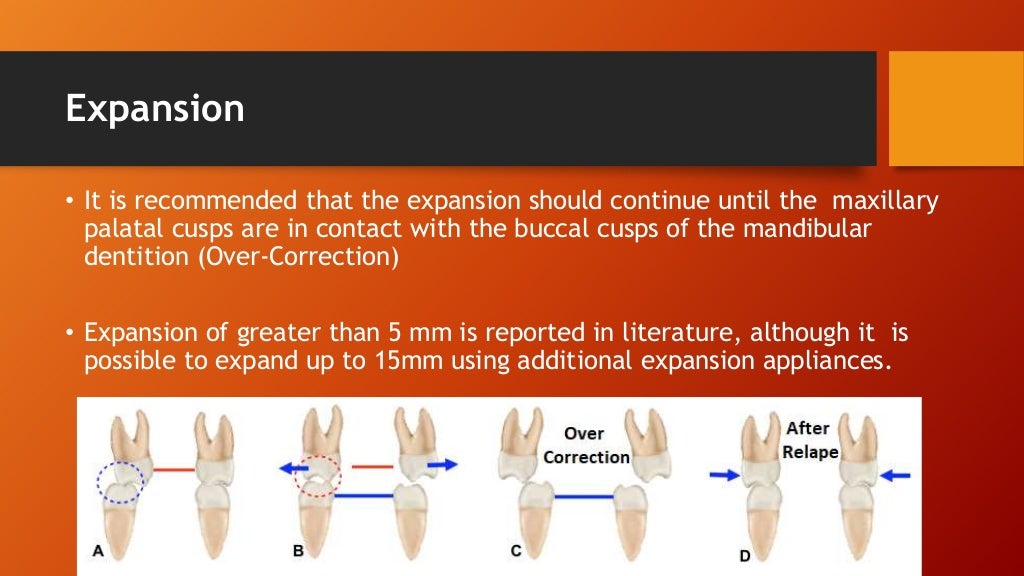 Orthognathic Surgical Procedure on non-growing patients with maxillar…