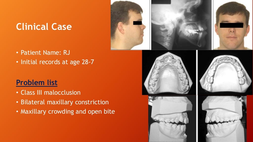 Orthognathic Surgical Procedure on non-growing patients with maxillar…