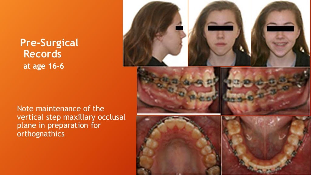 Orthognathic Surgical Procedure on non-growing patients with maxillar…