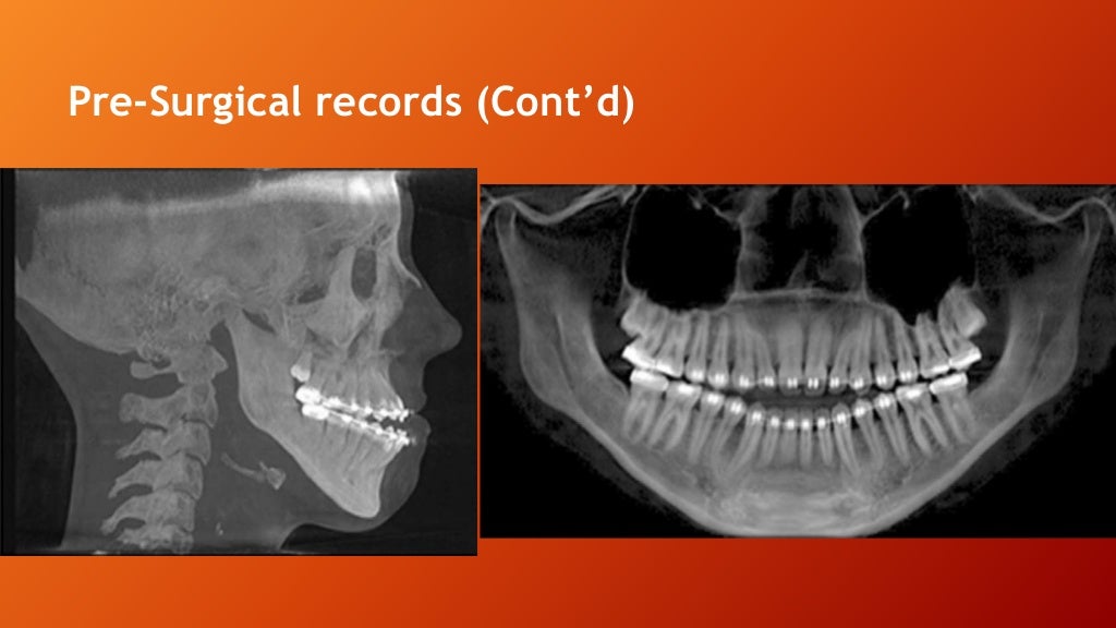 Orthognathic Surgical Procedure on non-growing patients with maxillar…