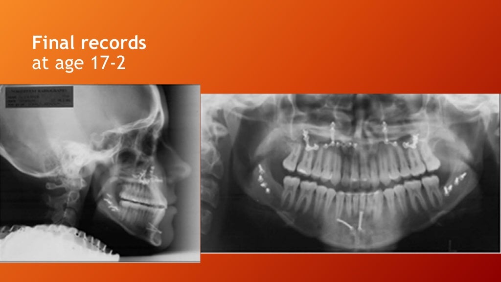Orthognathic Surgical Procedure on non-growing patients with maxillar…