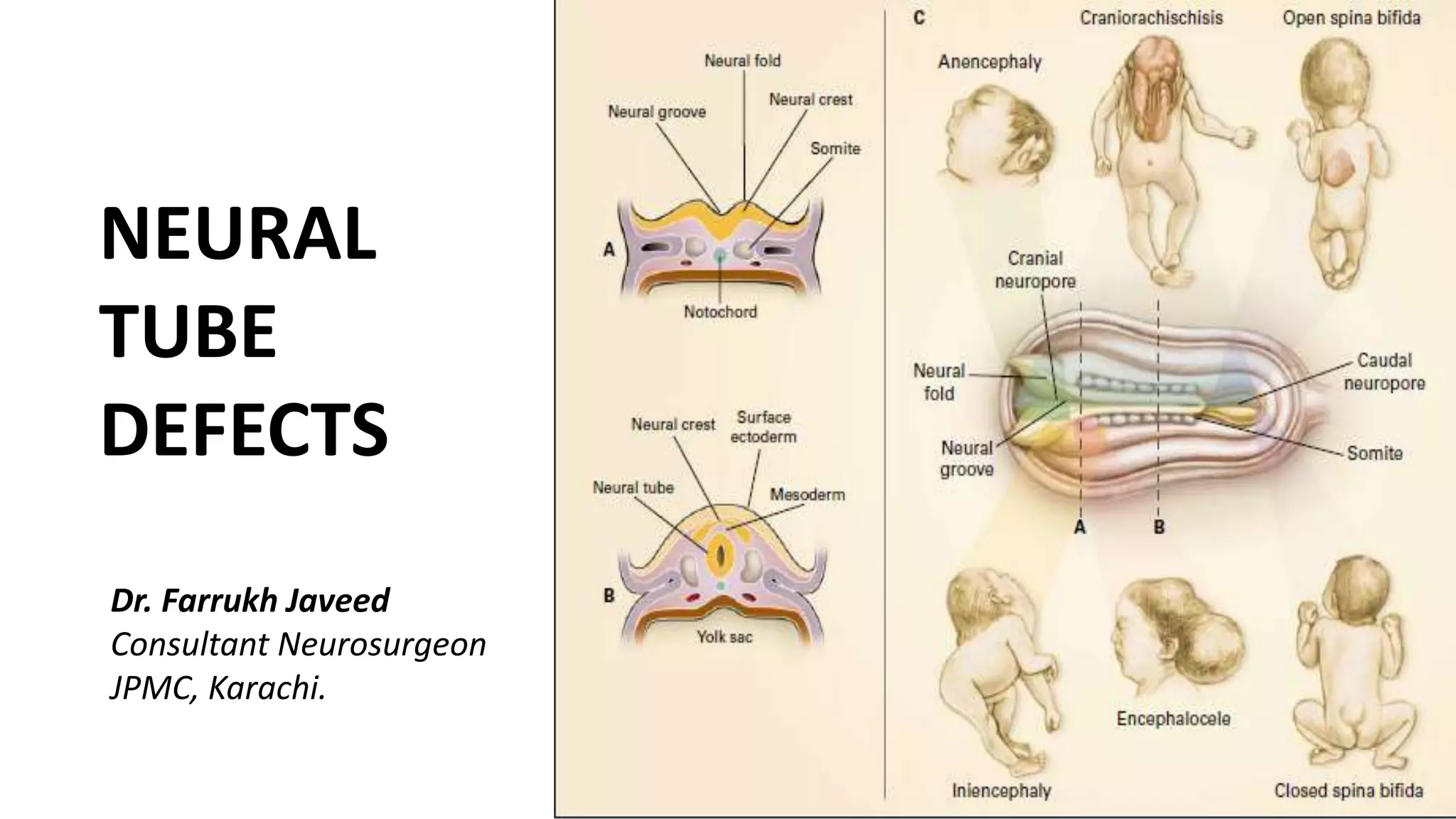 Neural Tube Defects for Undergraduate Medical Students | PPT