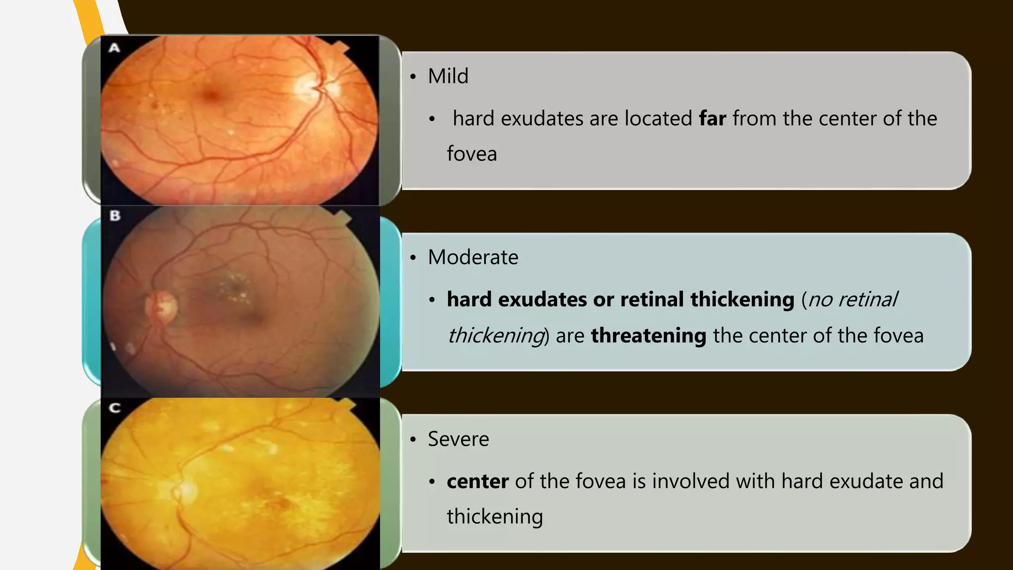 Diabetic retinopathy | PPTX