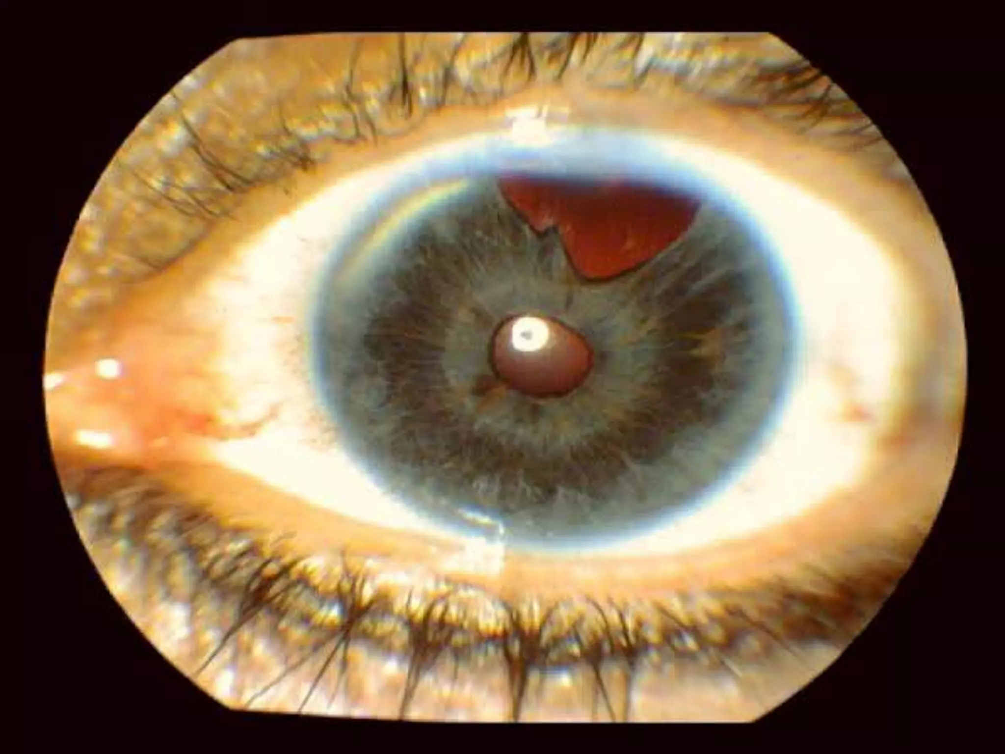 Acute Congestive Glaucoma / Optic Neuritis / Painful Loss Of Vision by ...