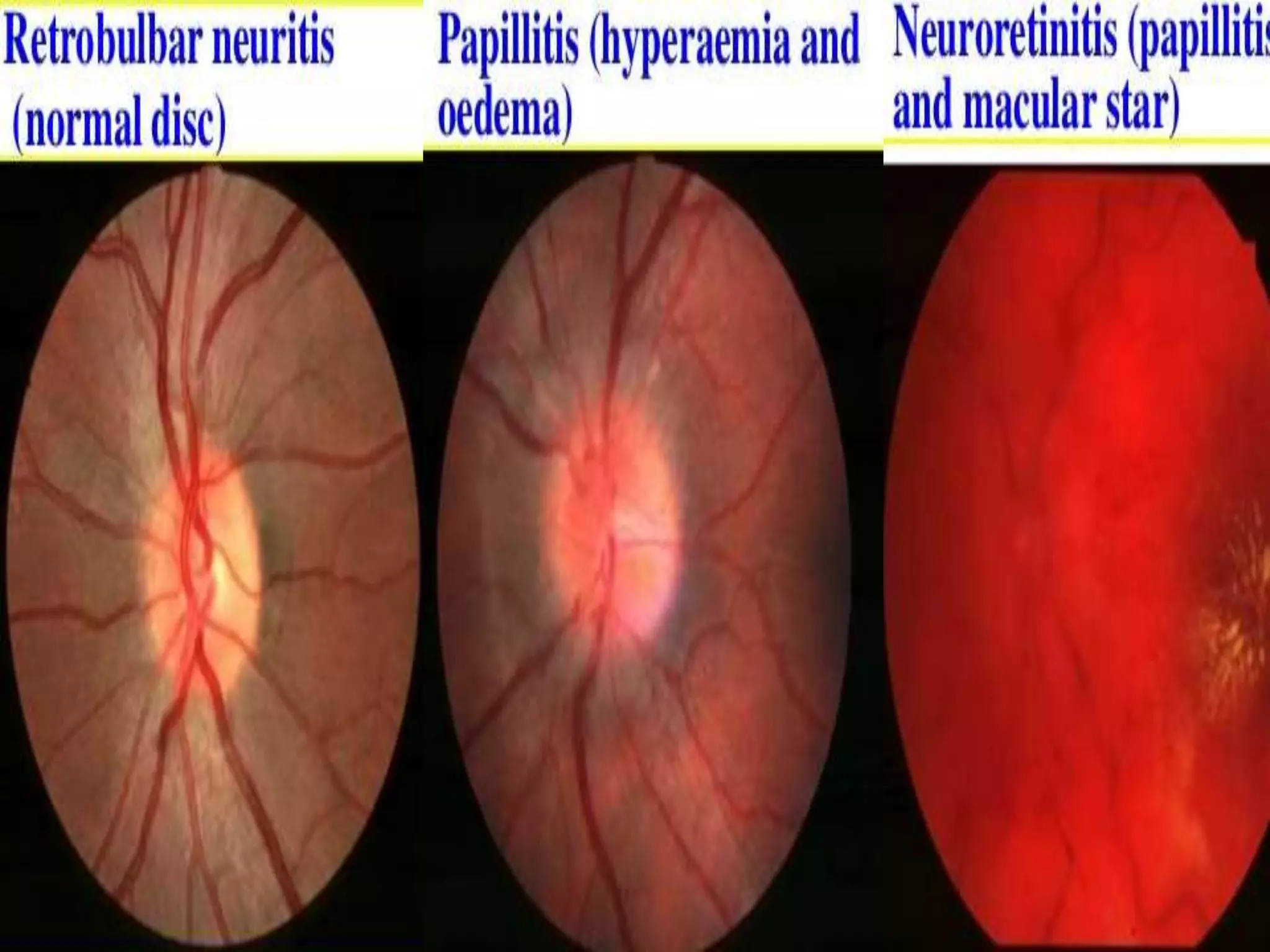 Acute Congestive Glaucoma / Optic Neuritis / Painful Loss Of Vision by ...