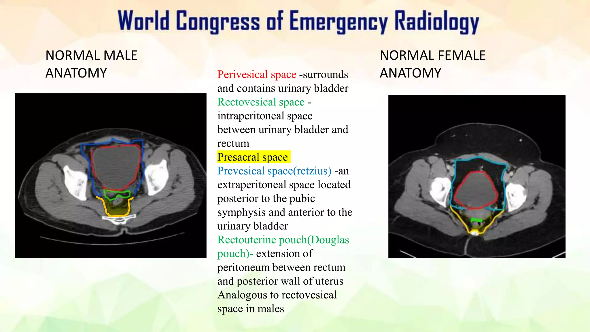 IMAGING FEATURES OF BLADDER TRAUMA ON CT CYSTOGRAPHY | PPTX