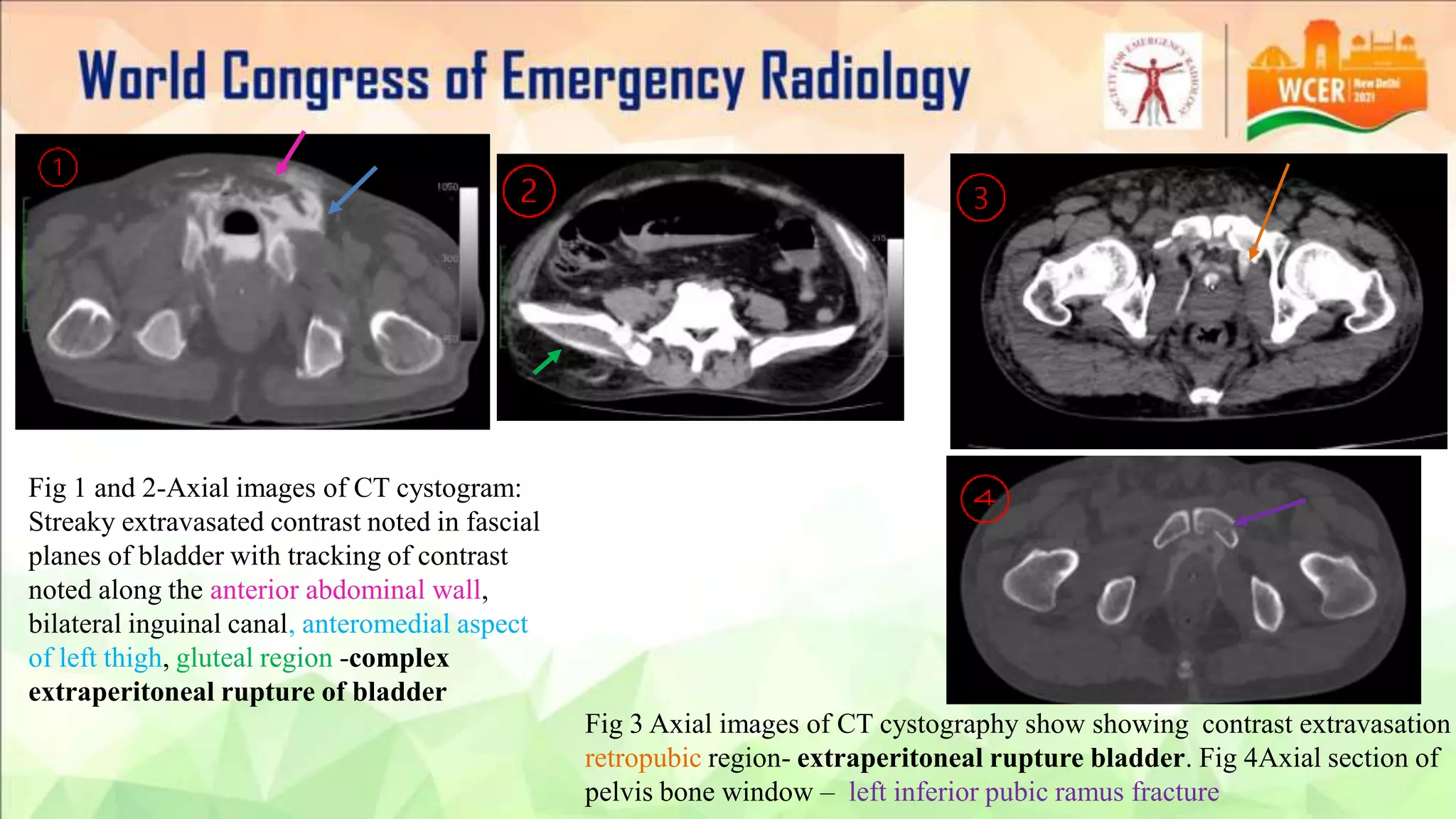 IMAGING FEATURES OF BLADDER TRAUMA ON CT CYSTOGRAPHY | PPTX