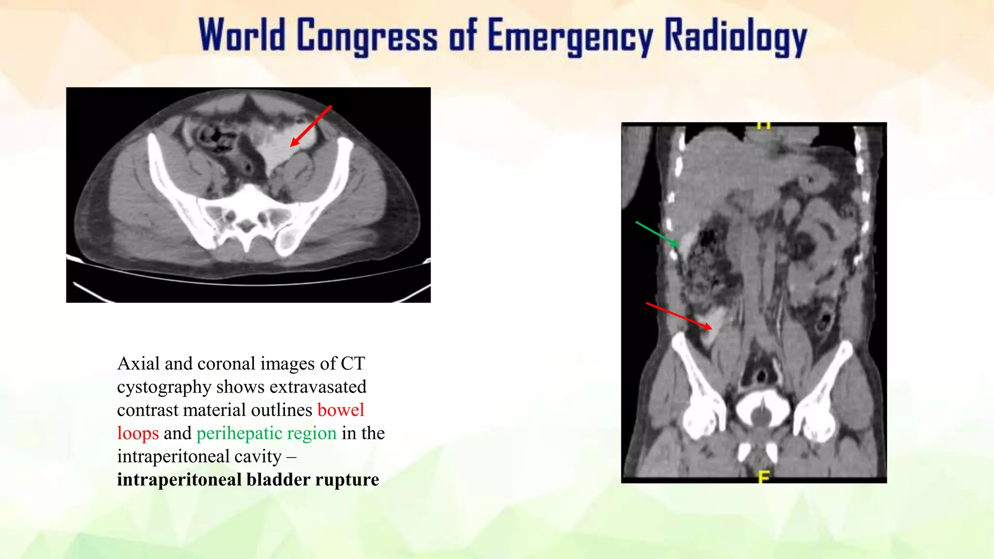IMAGING FEATURES OF BLADDER TRAUMA ON CT CYSTOGRAPHY | PPTX