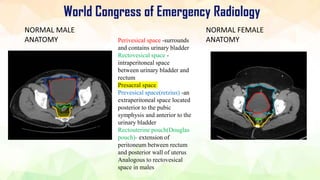 IMAGING FEATURES OF BLADDER TRAUMA ON CT CYSTOGRAPHY | PPTX