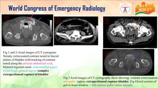 IMAGING FEATURES OF BLADDER TRAUMA ON CT CYSTOGRAPHY | PPTX