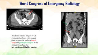 IMAGING FEATURES OF BLADDER TRAUMA ON CT CYSTOGRAPHY | PPTX