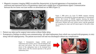 Ectopic Pregnancy in the Rudimentary Horn of a Unicornuate Uterus: The ...