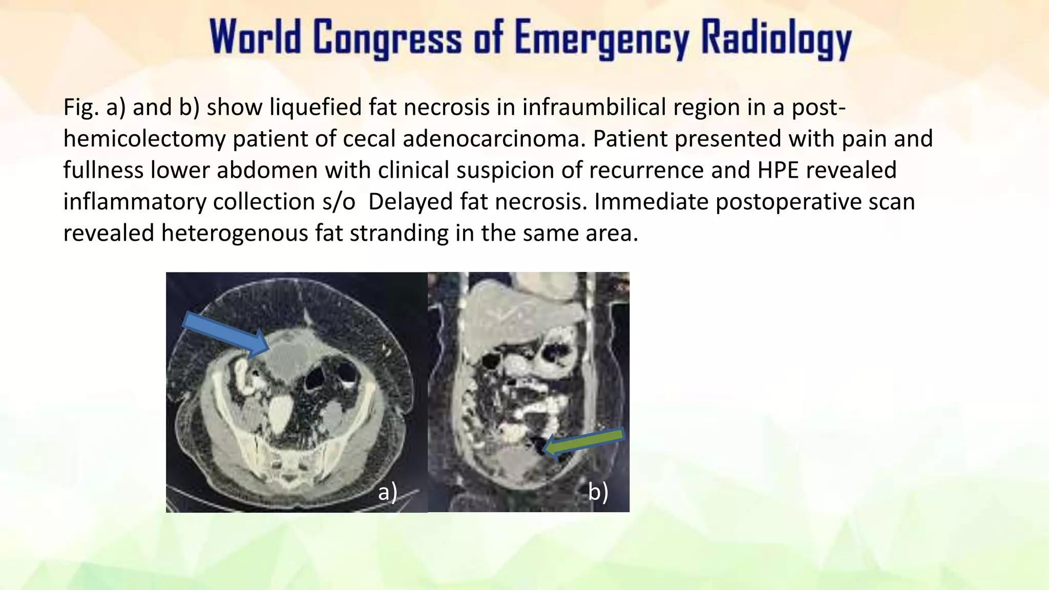 Imaging spectrum of Abdominal Fat Necrosis | PPTX