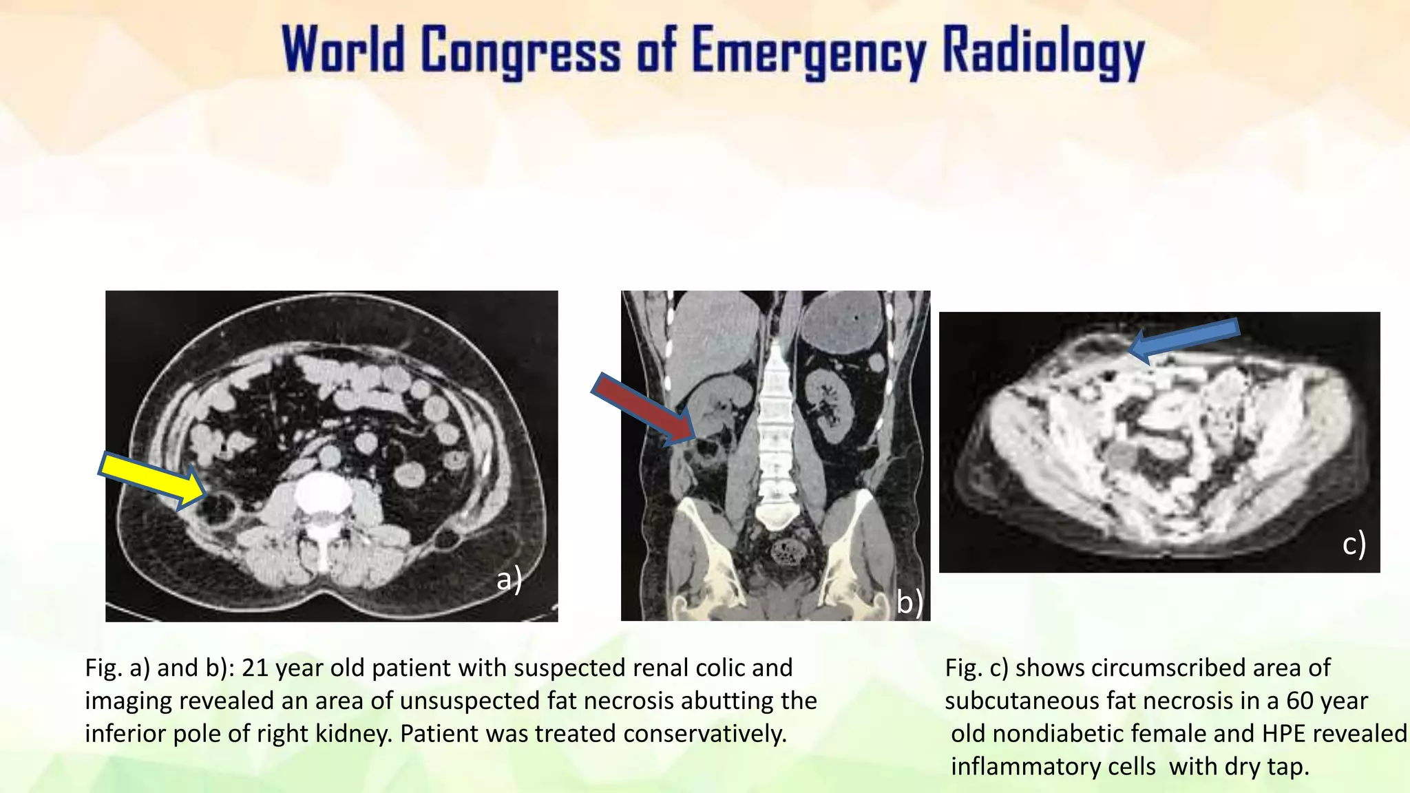 Imaging spectrum of Abdominal Fat Necrosis | PPTX
