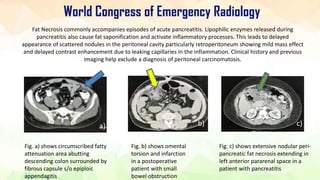 Imaging spectrum of Abdominal Fat Necrosis | PPTX | Digestive Disorders ...