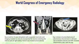 Imaging spectrum of Abdominal Fat Necrosis | PPTX