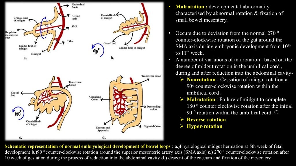 Midgut Volvulus And Malrotation An Unusual Cause Of Intestinal Obst…