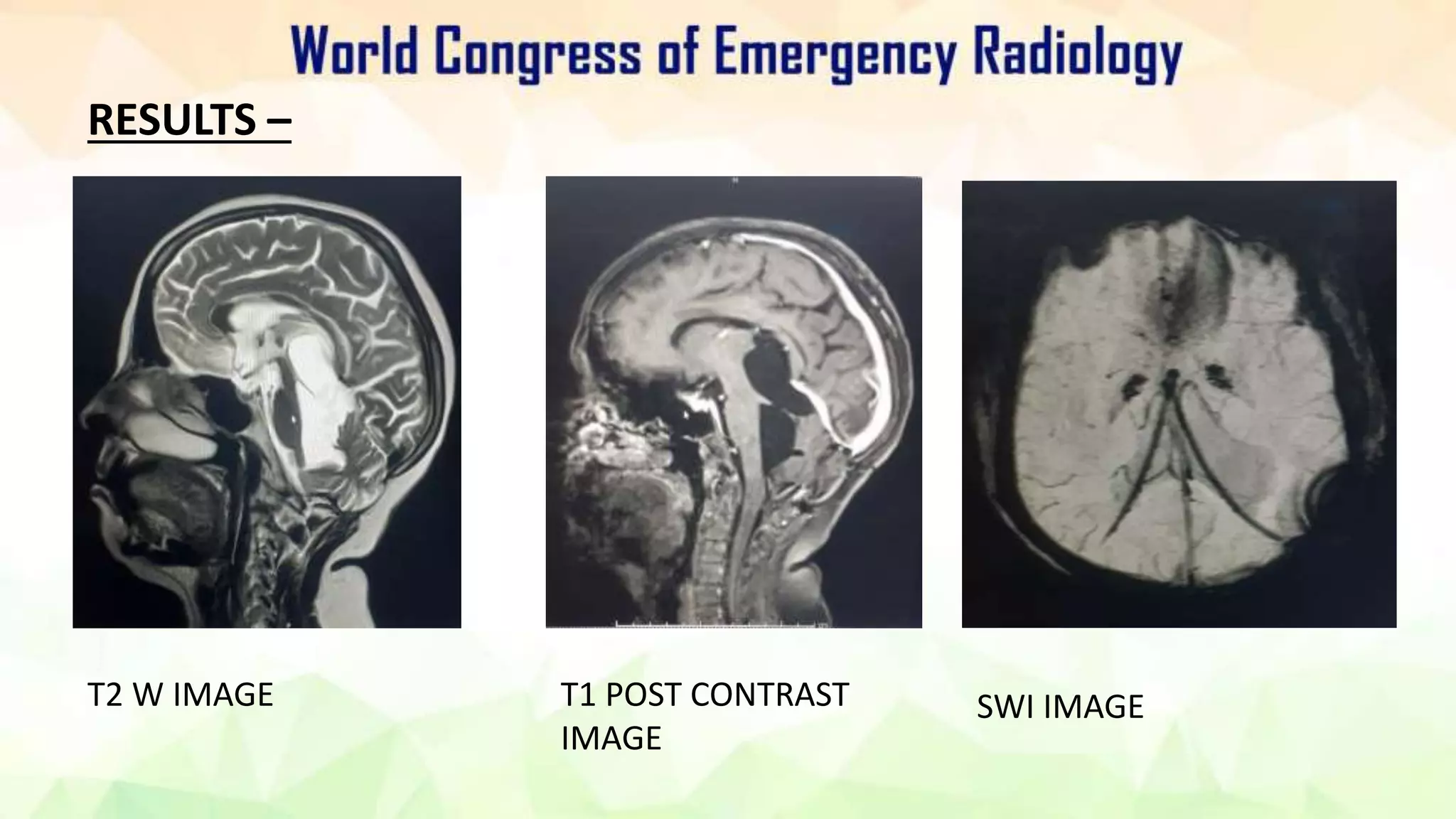 TECTAL PLATE CYST : AN UNUSUAL PRESENTATION | PPTX | Brain and Nervous ...