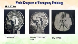 TECTAL PLATE CYST : AN UNUSUAL PRESENTATION | PPTX | Brain and Nervous ...