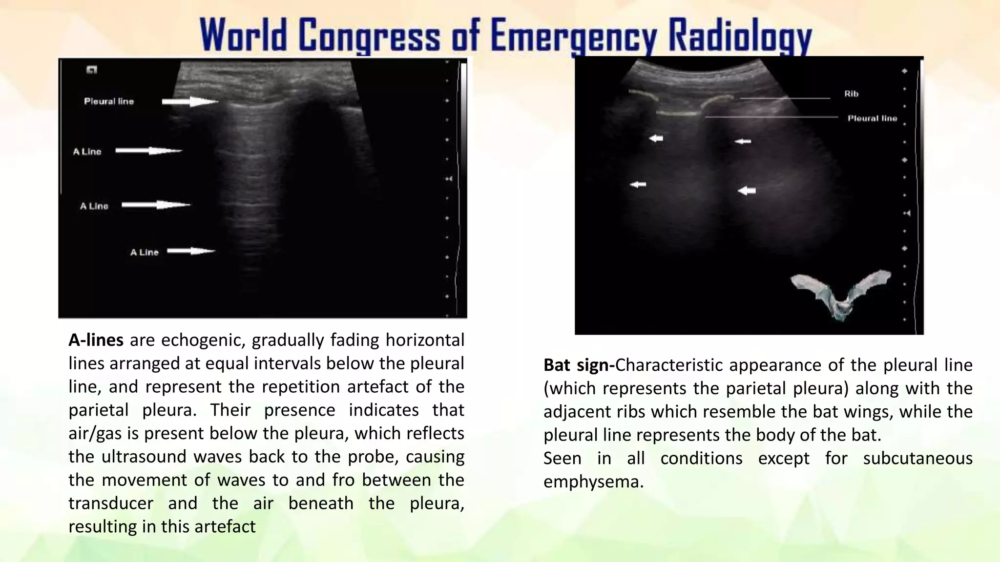 Normal Lung Ultrasound in Emergency: Technique and what to expect | PPT