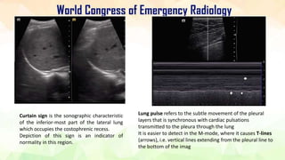 Normal Lung Ultrasound in Emergency: Technique and what to expect | PPTX