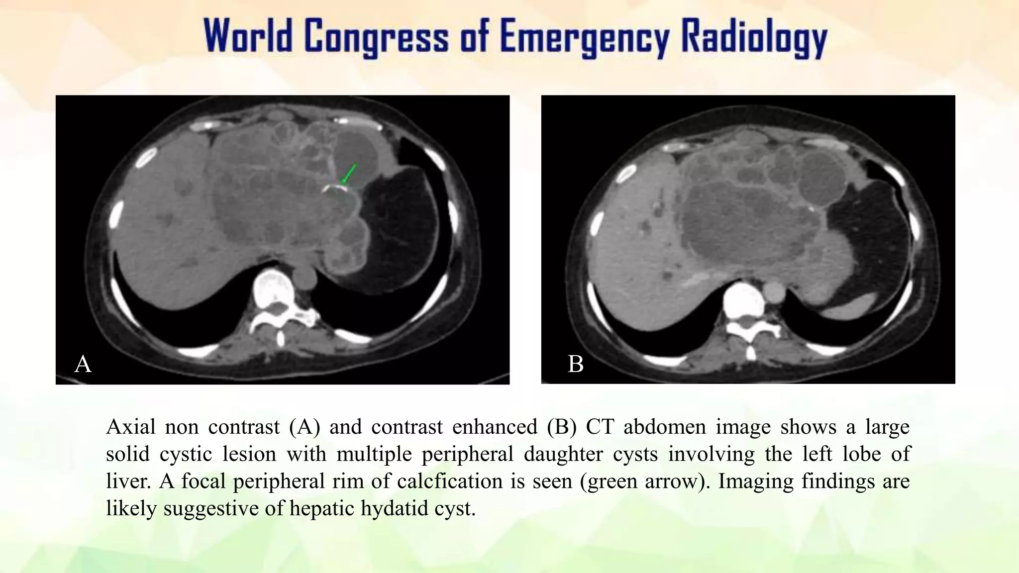 WHEN 20 YEARS POST EXCISION HEPATIC HYDATID CYST PRESENTED AS ...