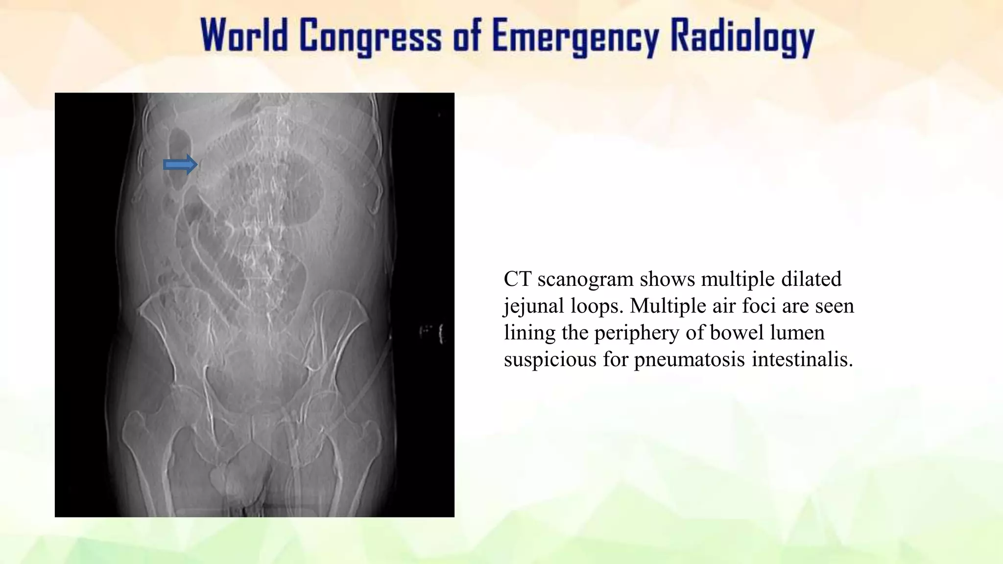 SPONTANEOUS SMA DISSECTION: AN UNUSUAL CAUSE OF INTESTINAL OBSTRUCTION ...