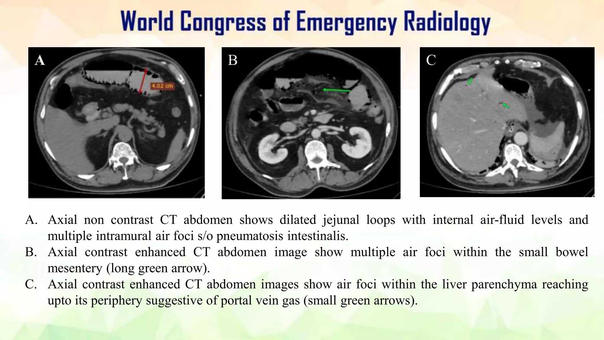 SPONTANEOUS SMA DISSECTION: AN UNUSUAL CAUSE OF INTESTINAL OBSTRUCTION ...