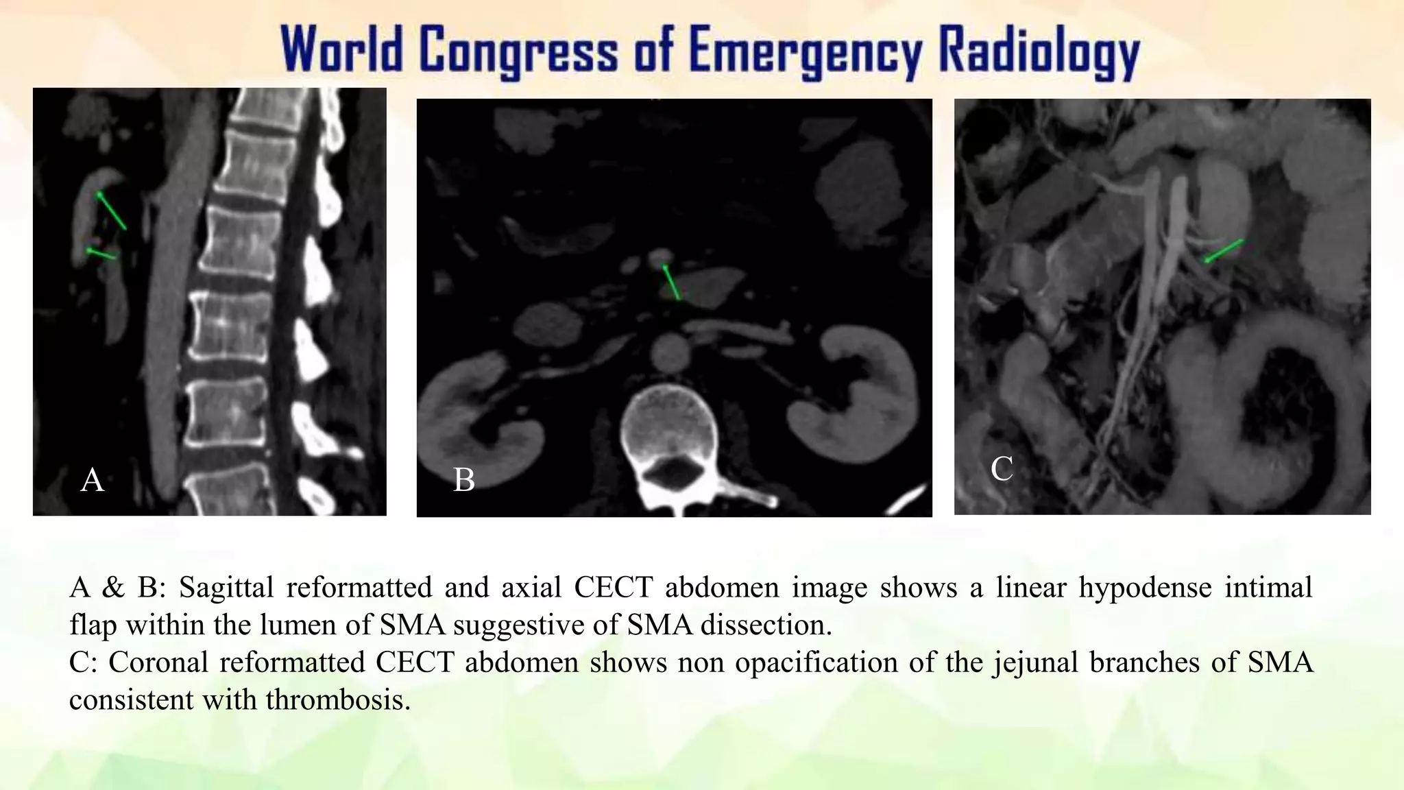 SPONTANEOUS SMA DISSECTION: AN UNUSUAL CAUSE OF INTESTINAL OBSTRUCTION ...