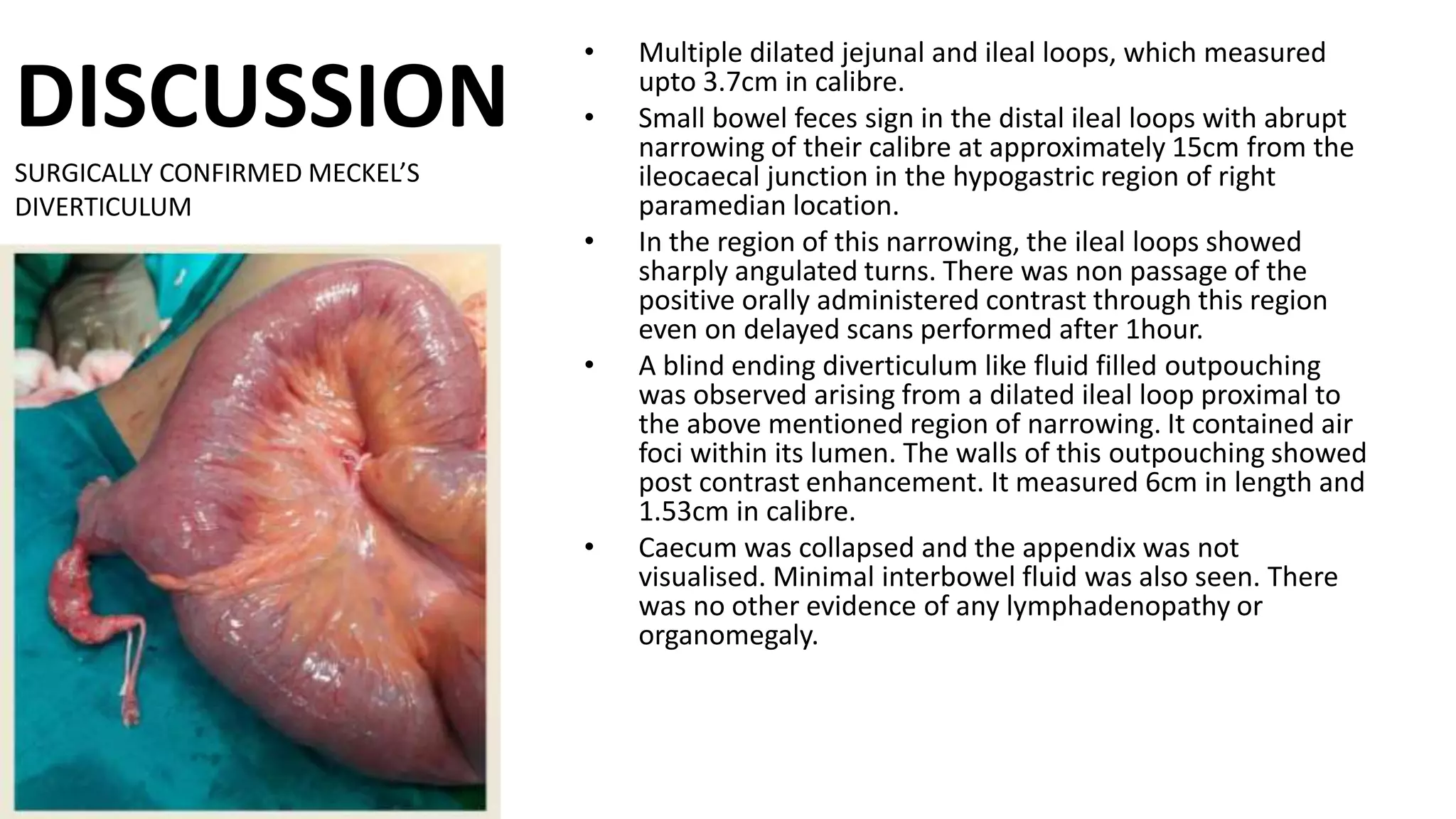 MECKELS DIVERTICULUM : A RARE CASE OF SMALL BOWEL OBSTRUCTION IN ADULTS ...