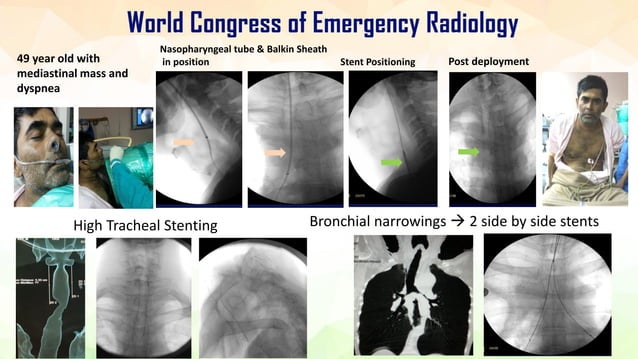 TRACHEO BRONCHIAL STENTING IN MALIGNANT AIRWAYS: a simple rapid trans ...
