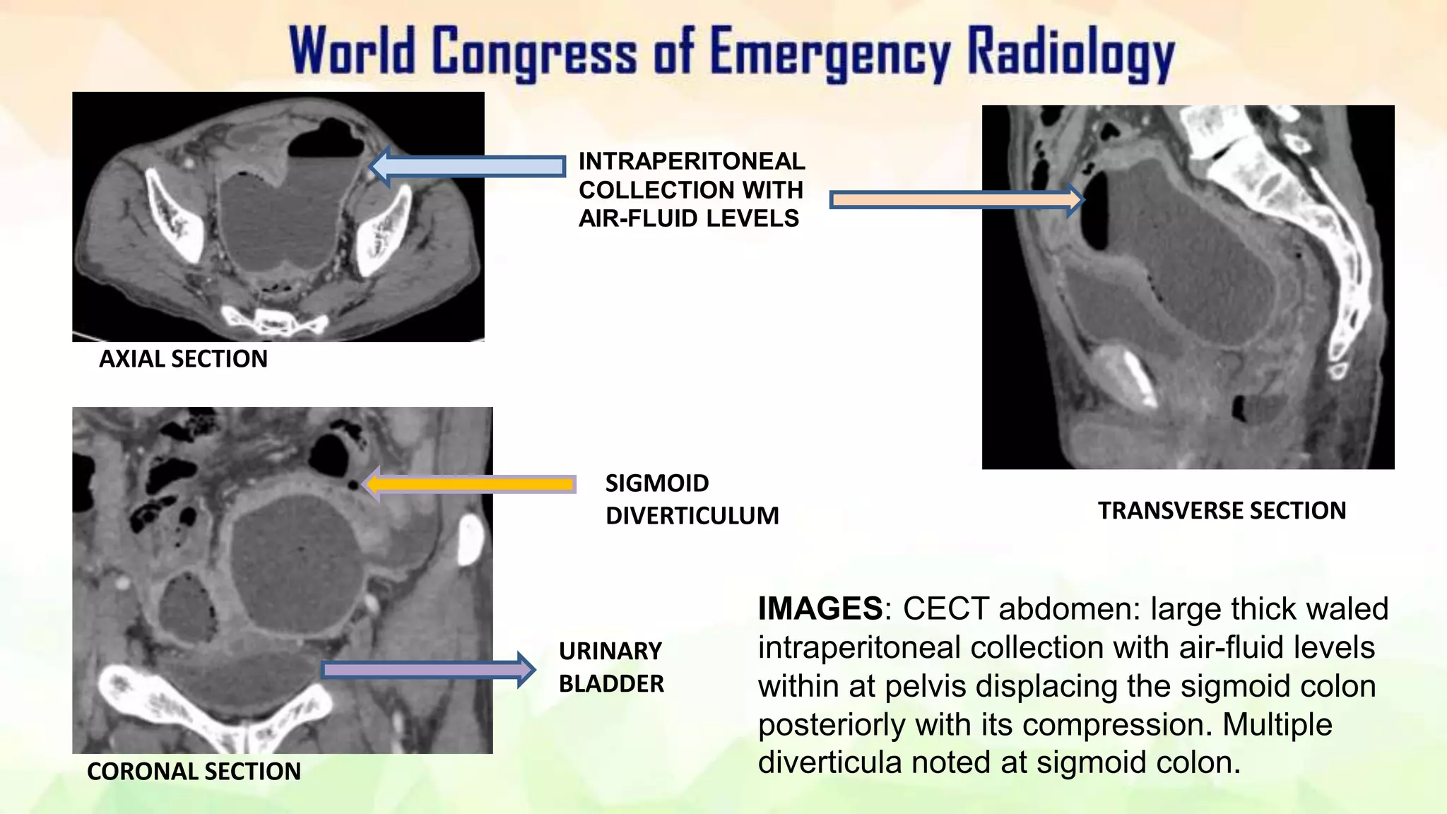 ACUTE PRESENTATION OF INTRAPERITONEAL ABSCESS: A DIAGNOSTIC DILEMMA | PPT