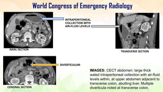 ACUTE PRESENTATION OF INTRAPERITONEAL ABSCESS: A DIAGNOSTIC DILEMMA | PPT