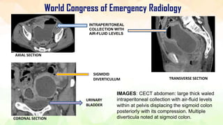 ACUTE PRESENTATION OF INTRAPERITONEAL ABSCESS: A DIAGNOSTIC DILEMMA | PPT