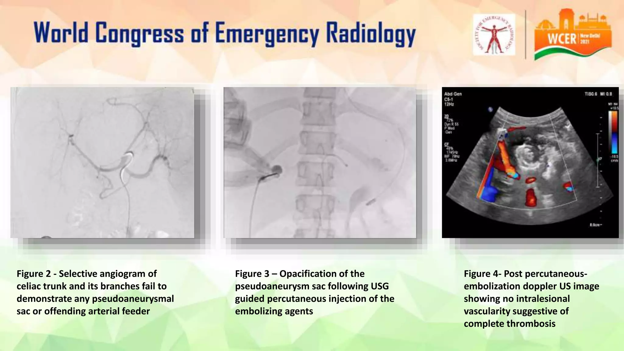 A rare case of percutaneous therapeutic embolization of pancreatitis ...