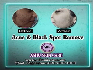 Dr. anita rath is best for hair transplant specilaist in bhubaneswar ...