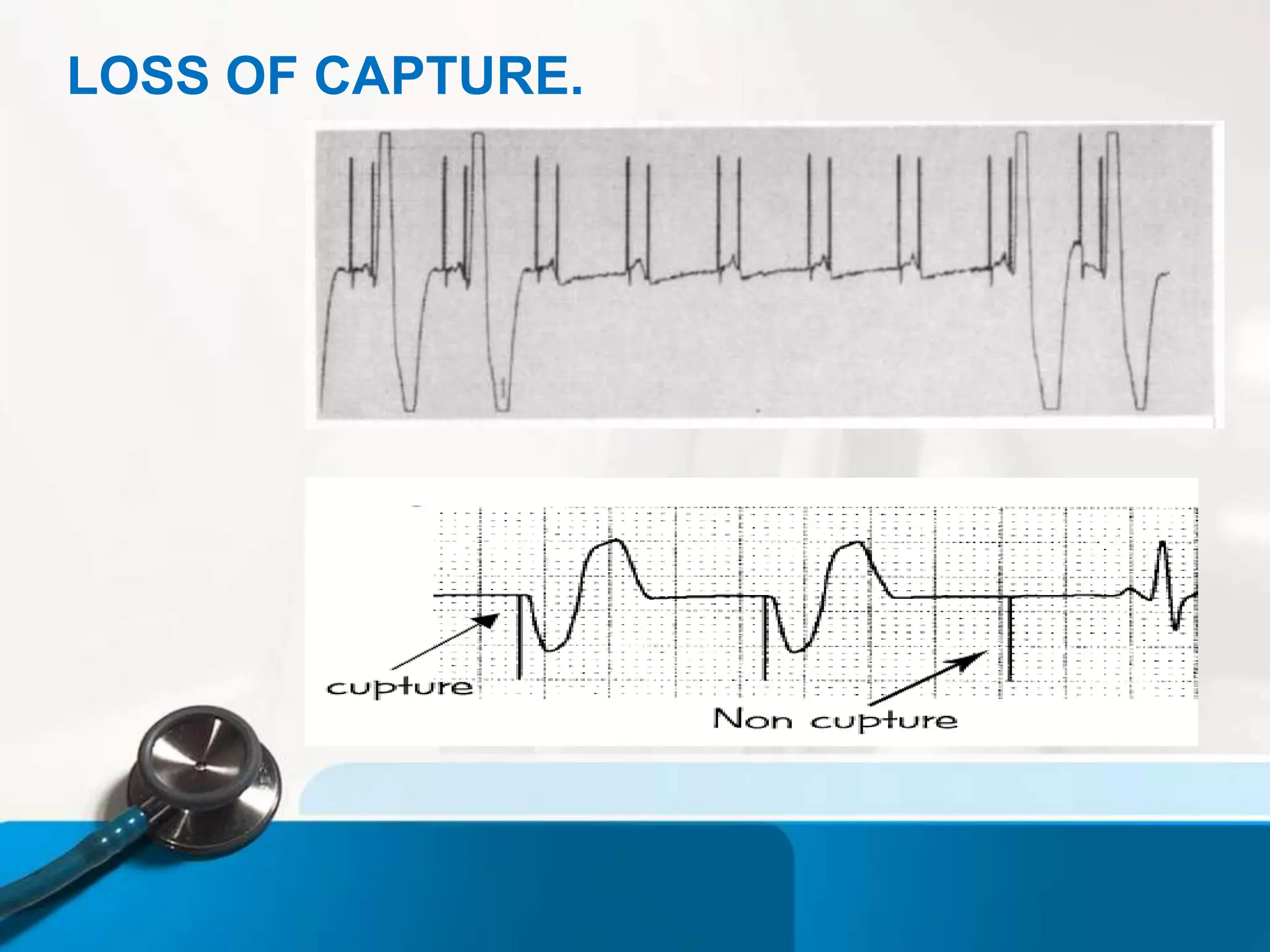 PACEMAKER by Dr.Sravani Vishnubhatla | PPTX