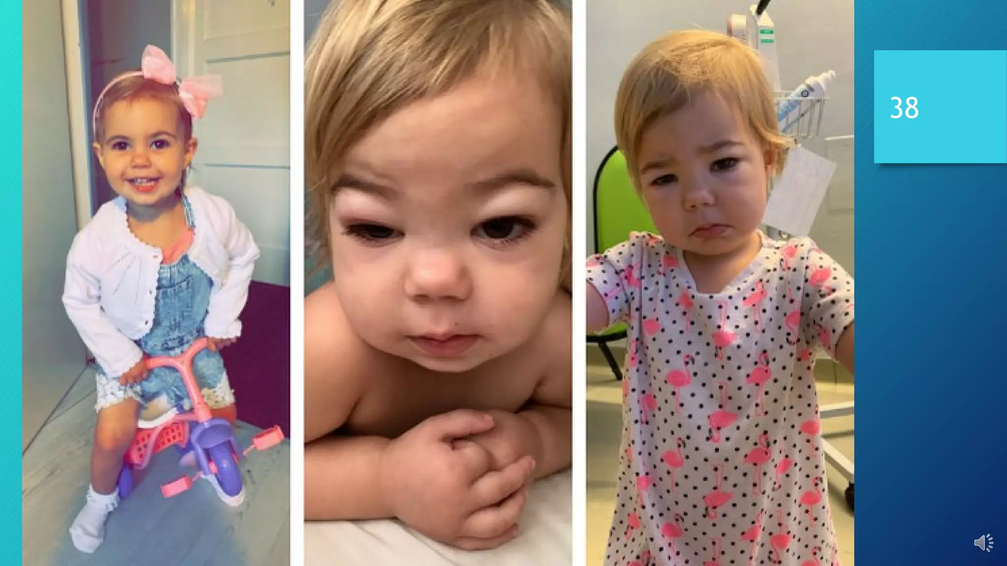 clinical approach to pediatric proteinuria | PDF