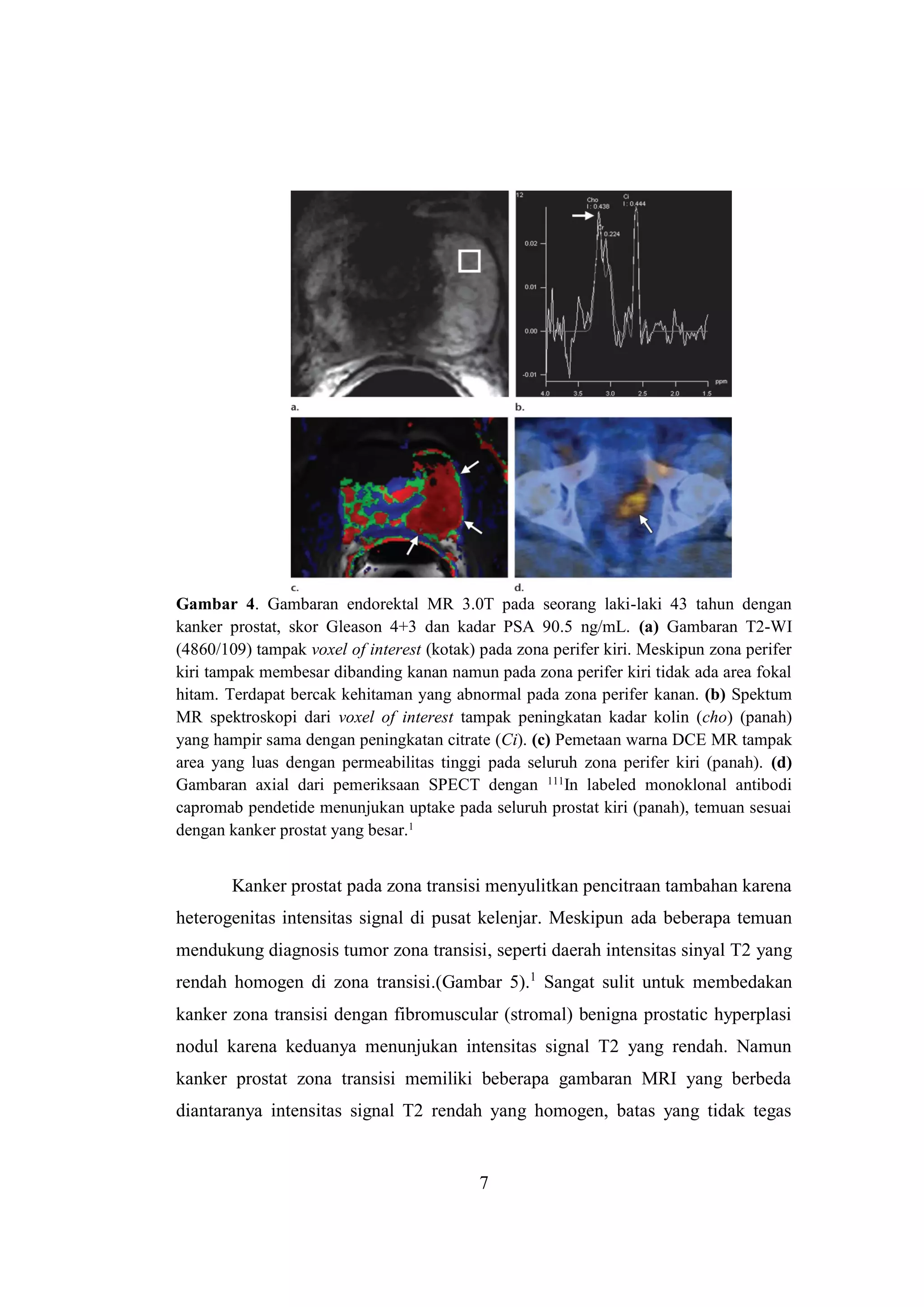dr. Adnan (Referat) Gambaran MRI Kanker Prostat.pdf