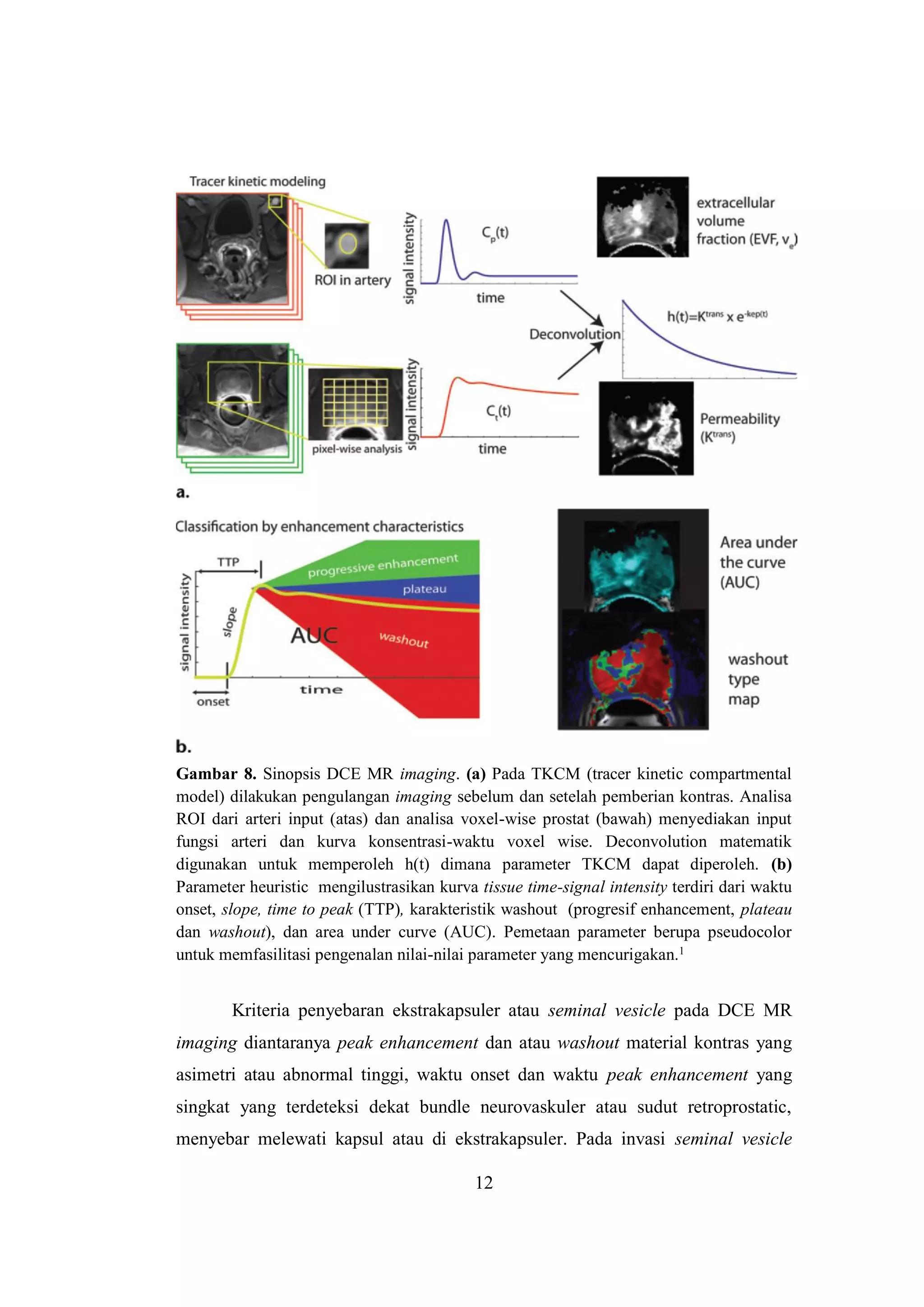 dr. Adnan (Referat) Gambaran MRI Kanker Prostat.pdf